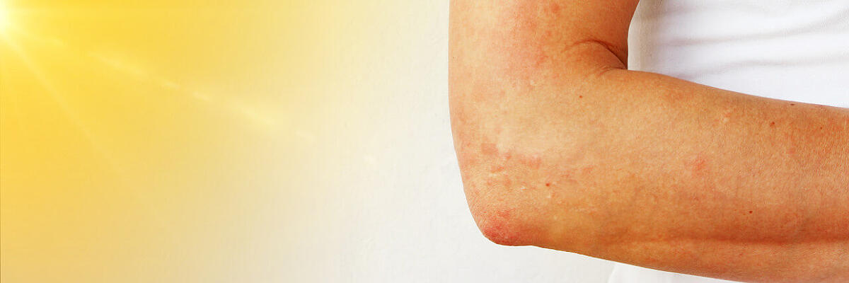 Sonnenallergie: Ursachen, Symptome, Behandlung