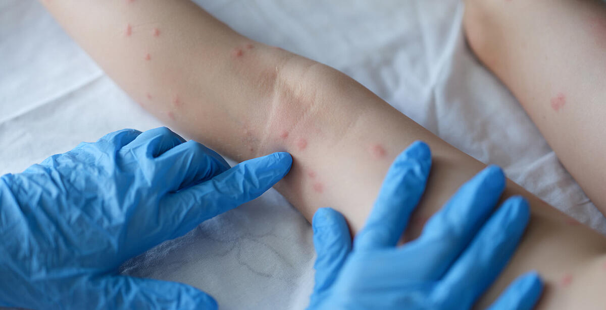 Windpocken – Symptome, Verlauf und Behandlung