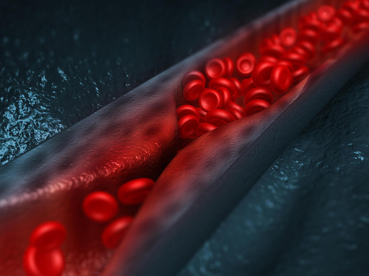 Schlaganfall (Apoplexie): Ursachen, Symptome & Behandlung